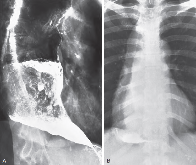 Acalasia – Gastro Mérida