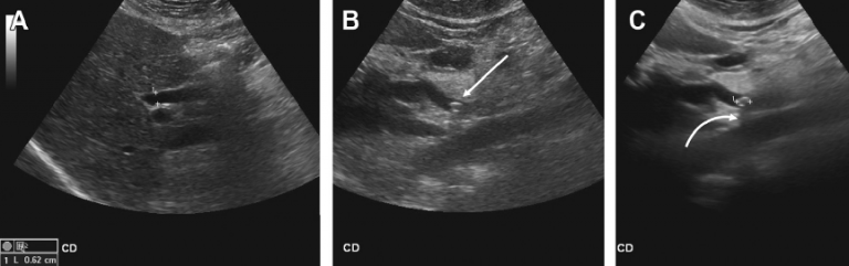 Colecistitis y Colangitis Aguda – Gastro Mérida
