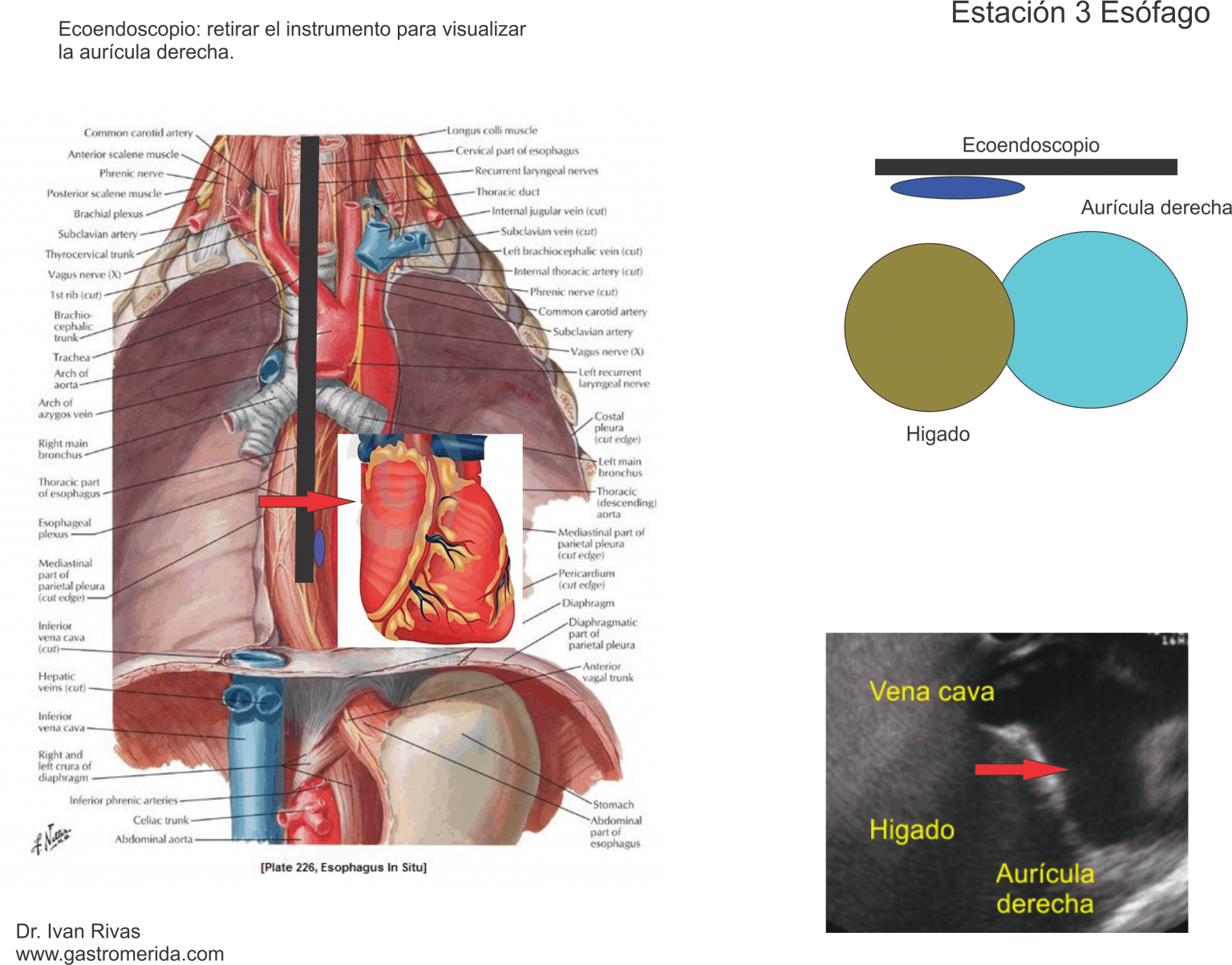 Ultrasonido Endoscópico Lineal de Esófago (Estaciones) – Gastro Mérida