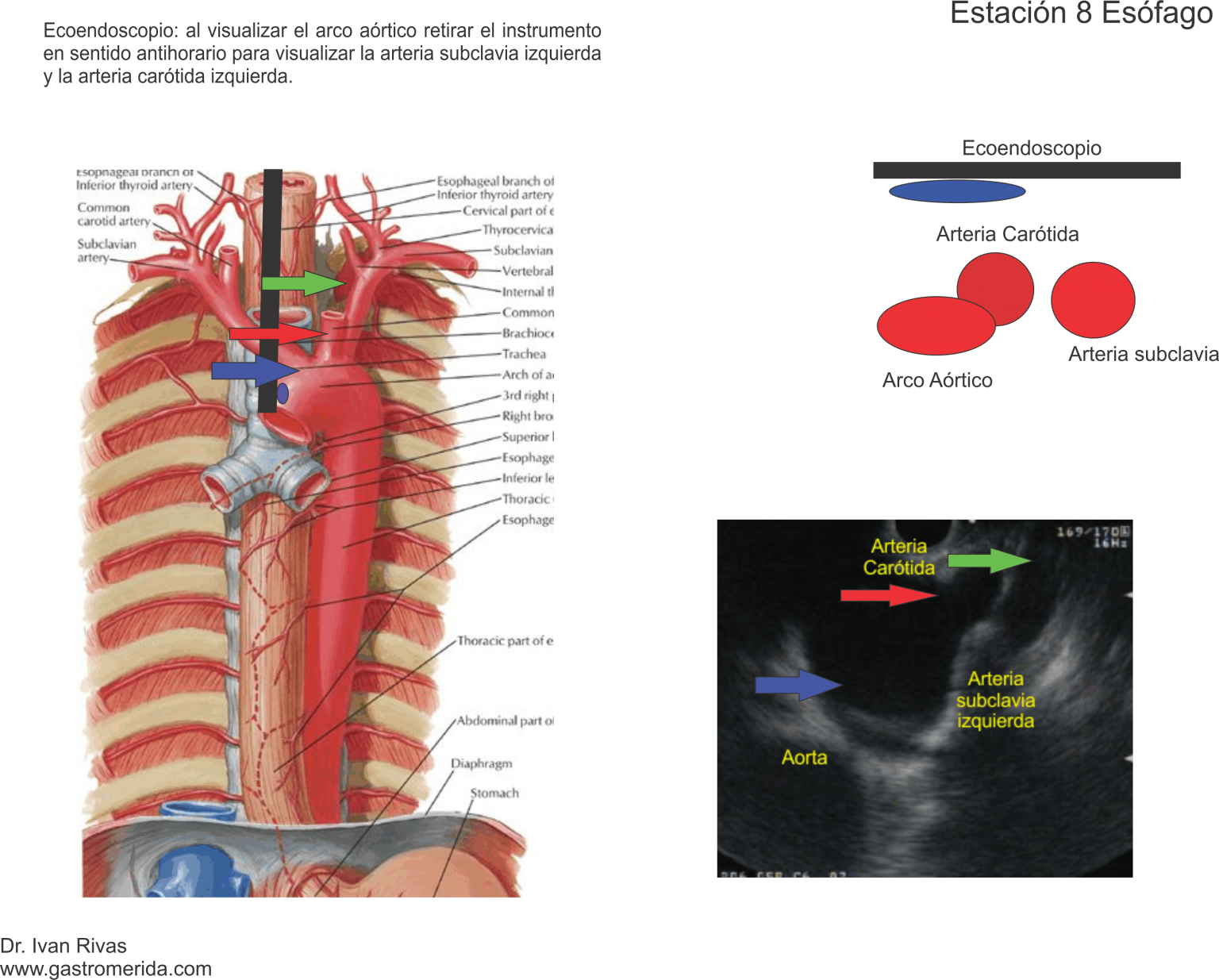 Ultrasonido Endoscópico Lineal de Esófago (Estaciones) – Gastro Mérida