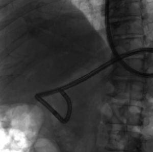 Manejo endoscópico de la Estenosis Biliar distal – Gastro Mérida