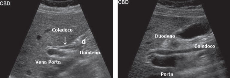 Ultrasonido de la Vesícula y el Árbol Biliar – Gastro Mérida