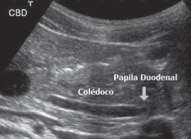 Ultrasonido de la Vesícula y el Árbol Biliar – Gastro Mérida