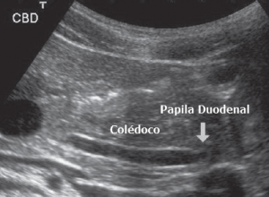 Ultrasonido de la Vesícula y el Árbol Biliar – Gastro Mérida
