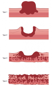 Actualización Cáncer Gástrico y Atrofia Gástrica – Gastro Mérida