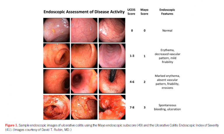 ndices Endosc picos En Enfermedad Inflamatoria Intestinal Gastro M rida ndices-endosc-picos-en-enfermedad-inflamatoria-intestinal-gastro-m-rida