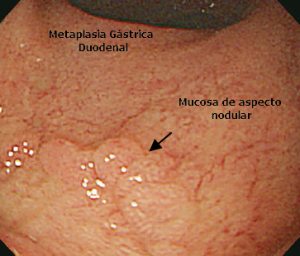 Endoscopia del Duodeno – Gastro Mérida