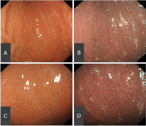 Manejo de la Infección por Helicobacter pylori en 2022 – Gastro Mérida