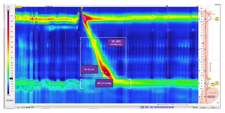 esfínter esofágico superior – Gastro Mérida