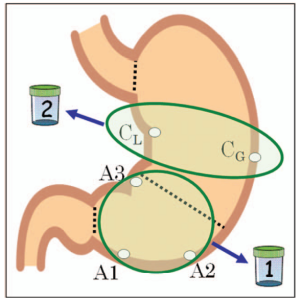Algoritmos para el manejo de la Metaplasia Intestinal – Gastro Mérida