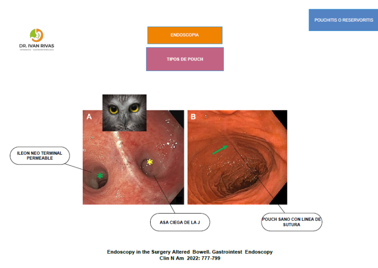 Algoritmos de buena práctica en diagnóstico y tratamiento de colitis ...