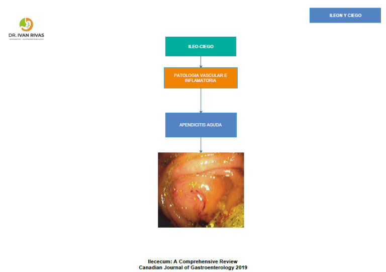 Algoritmos diagnósticos en Íleon y Ciego: Ileoscopia – Gastro Mérida