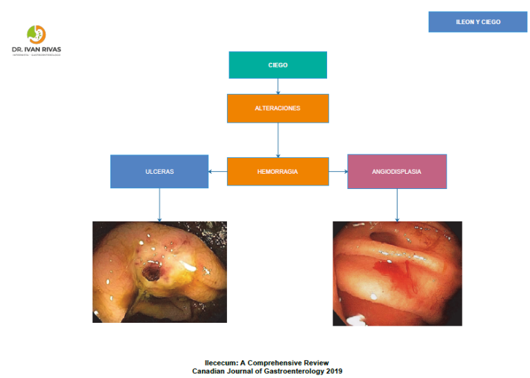 Algoritmos diagnósticos en Íleon y Ciego: Ileoscopia – Gastro Mérida