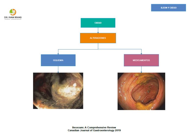 Algoritmos diagnósticos en Íleon y Ciego: Ileoscopia – Gastro Mérida