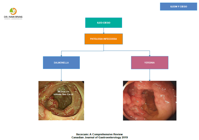 Algoritmos diagnósticos en Íleon y Ciego: Ileoscopia – Gastro Mérida