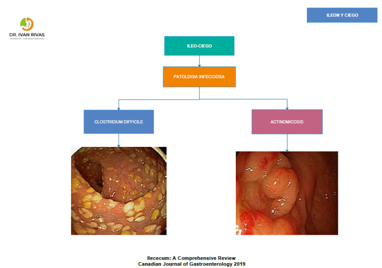 Algoritmos diagnósticos en Íleon y Ciego: Ileoscopia – Gastro Mérida