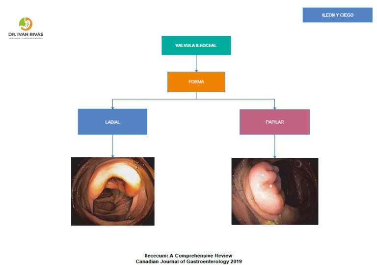 Algoritmos diagnósticos en Íleon y Ciego: Ileoscopia – Gastro Mérida