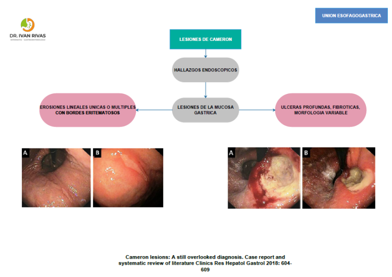 Algoritmos de buena práctica de la Union Esofagogastrica: Hernia Hiatal ...