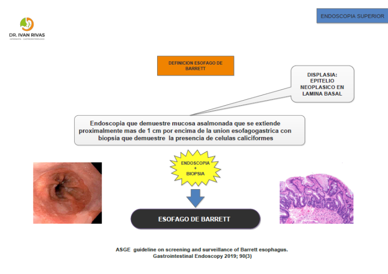 Algoritmos de buena práctica de la Union Esofagogastrica: Hernia Hiatal ...