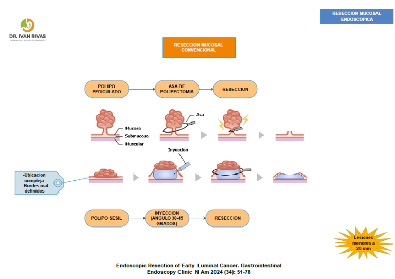 Técnicas endoscópicas: Polipectomía, Resección mucosal endoscópica ...