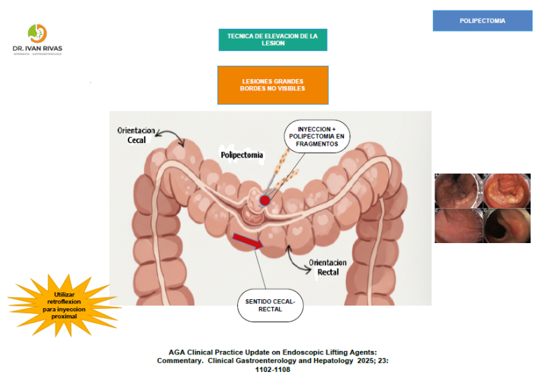 Técnicas endoscópicas: Polipectomía, Resección mucosal endoscópica ...